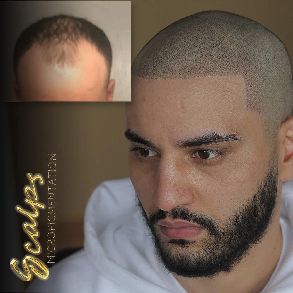 Gallery - SCALPS | Scalp Micropigmentation Centers SMP