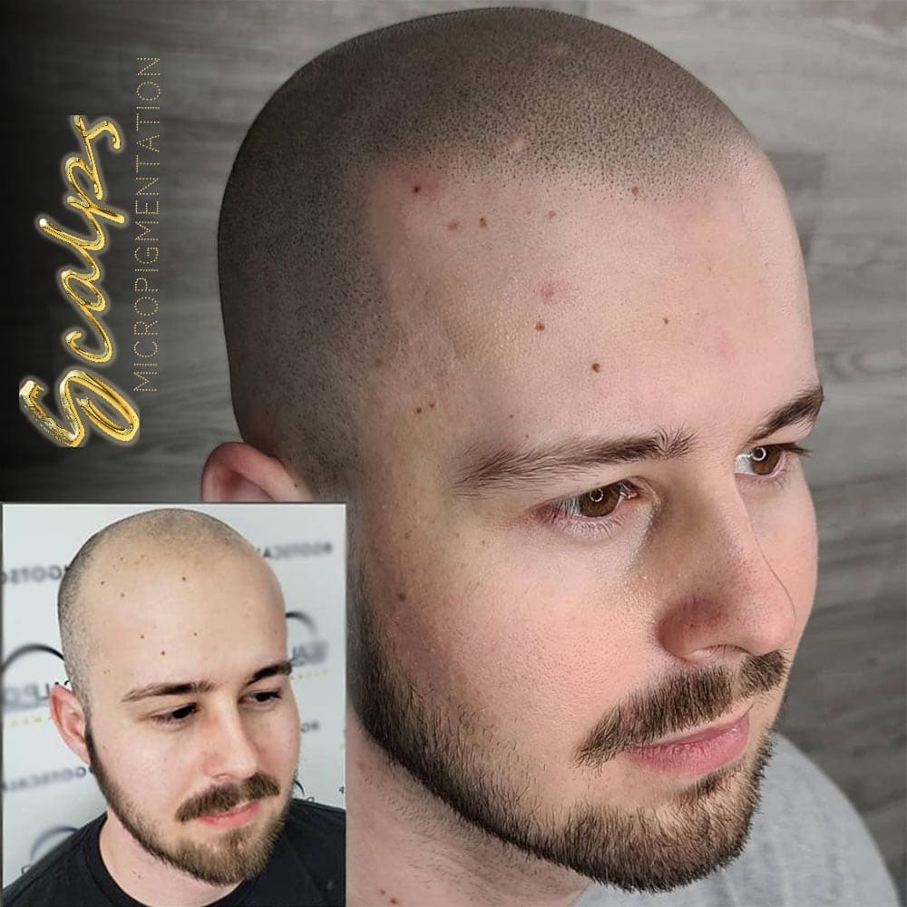 Gallery - SCALPS | Scalp Micropigmentation Centers SMP